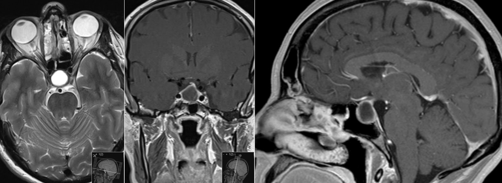 Radiology MRI: Rathke Cleft Cyst