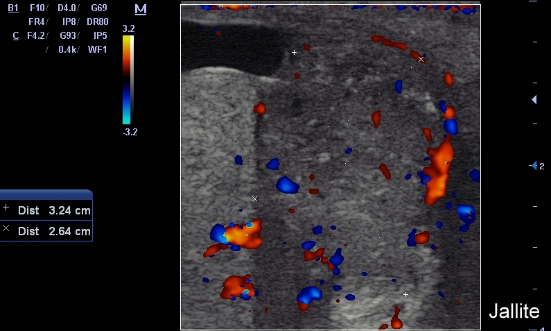 Tuberculosis Testicular