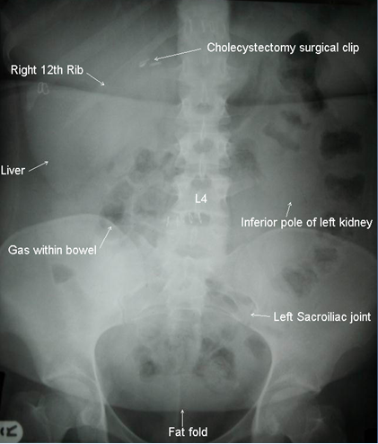 Radiographic positioning: Abdomen Radiograph