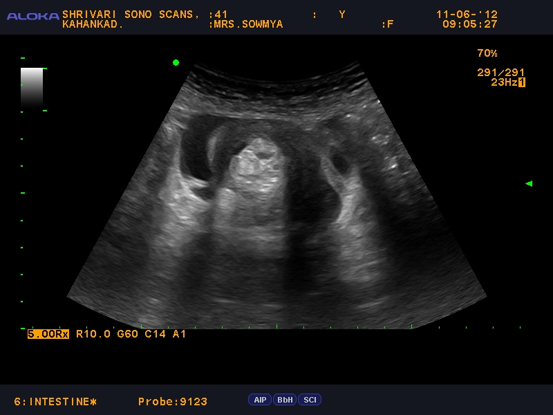 Shrivari Sono Scans: Small bowel intussusception secondary to ...