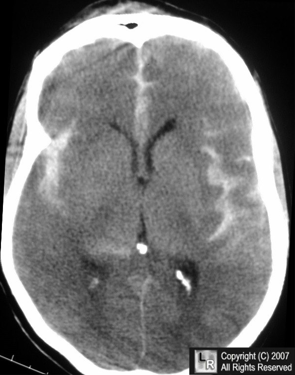Brain Bleed: Brain Bleed On Ct