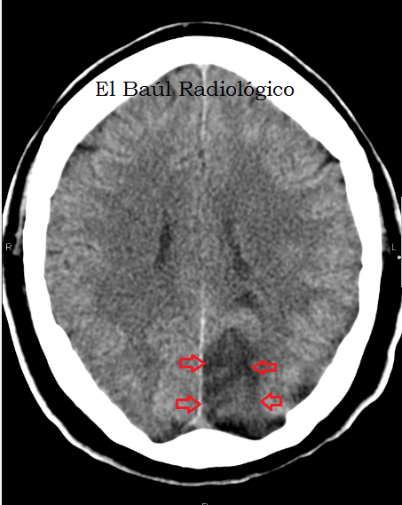 El Baúl Radiológico: POCI: DISTRIBUCIÓN TERRITORIAL. HALLAZGOS EN ...