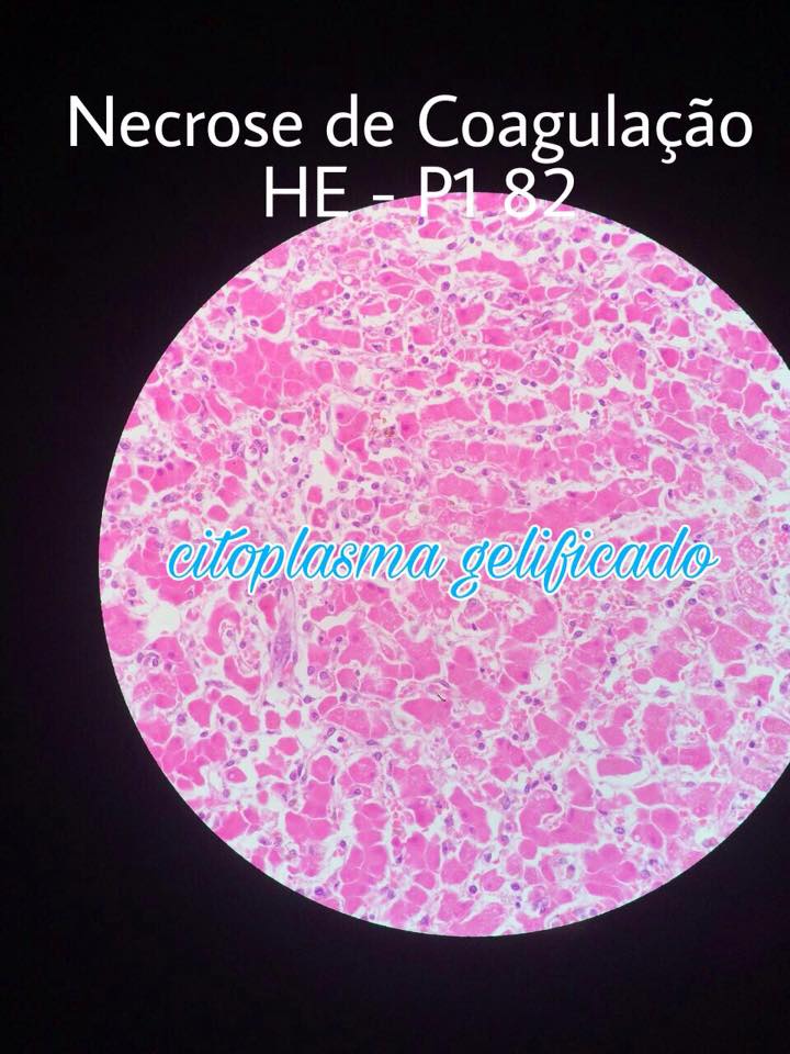 HISTOLOGIA90: TIPOS DE NECROSE