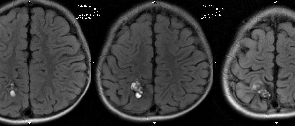 Neuroradiology Cases: Cavernoma with popcorn ball appearance MRI