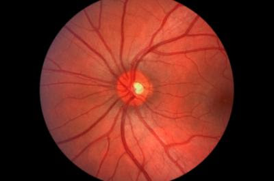 Update on Alzheimer's Detection and the Eye - Eyedolatry