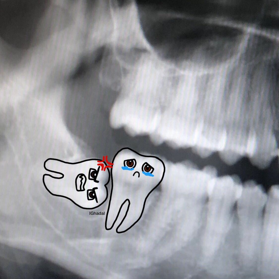 Horizontal 3rd Molar Impaction - Tooth Fairy Blog