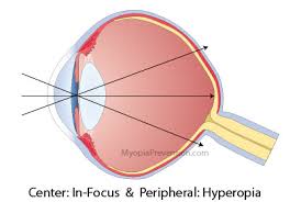What's Happening to Our Vision? Peripheral Defocus and Myopia ...