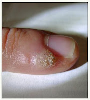 Dermatología en la Costa del Sol: Doctor, tengo una verruga