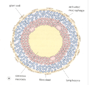 Dentistry and Medicine: Chronic Inflammation,Granulomatous Dieases ...