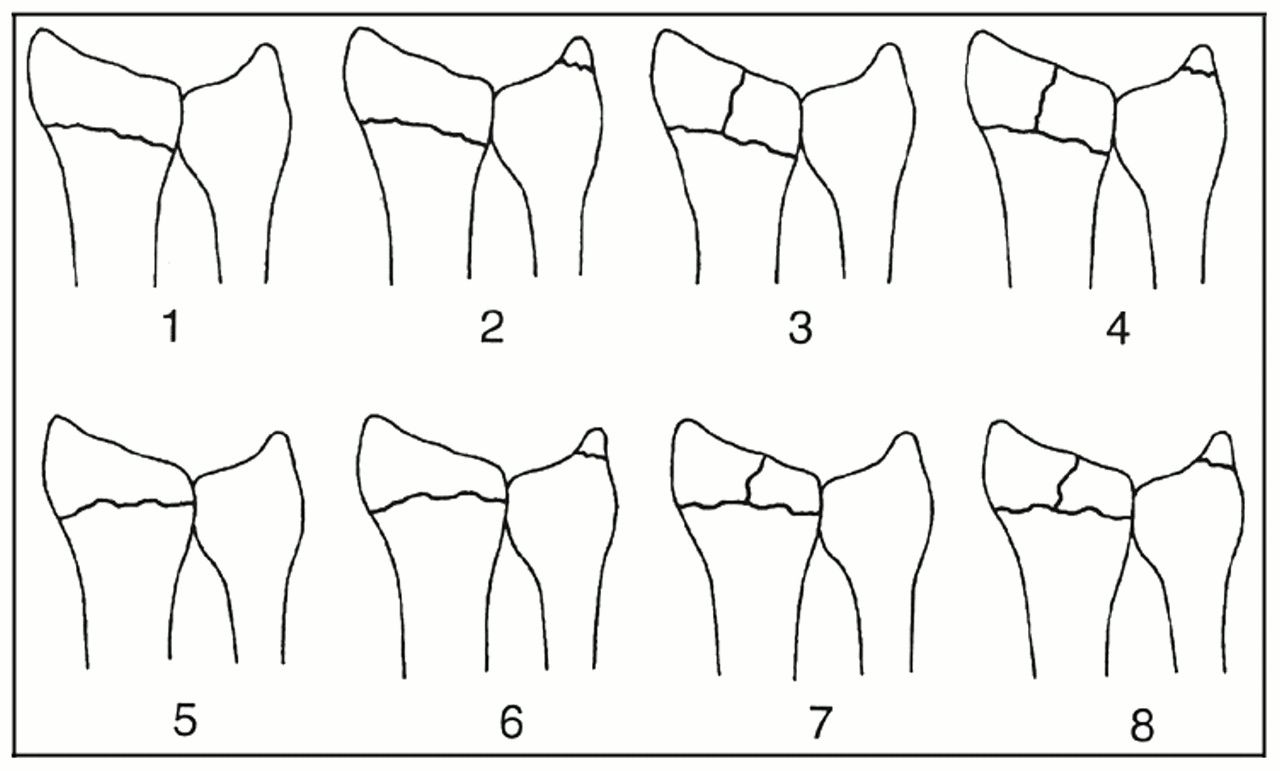 CASE PRESENTATION OF TYPE COLLES’ FRACTURE