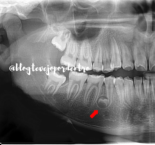"Te vejo por dentro": Terceiro pré- molar em formação