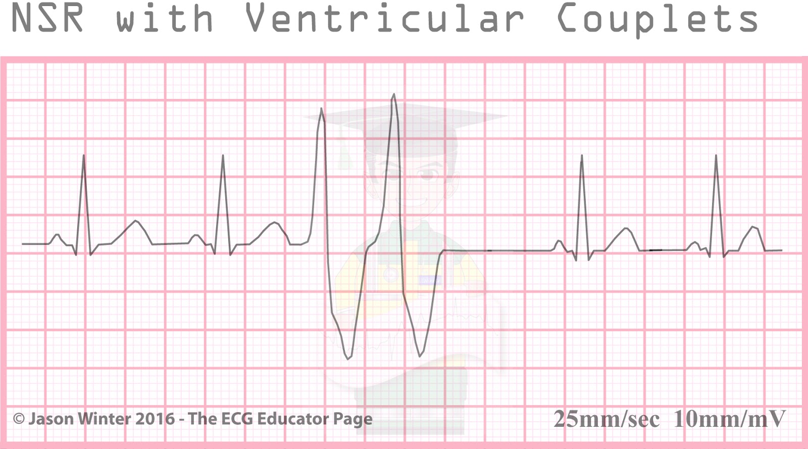 ECG Educator Blog : Ventricular Ectopics
