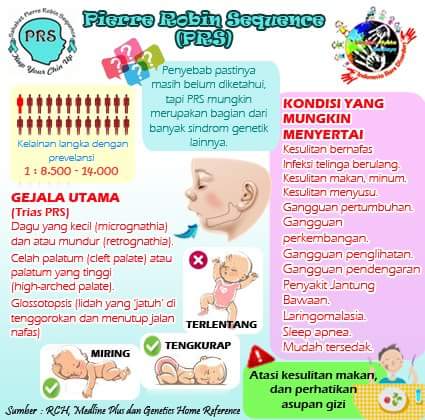 Mom2K's World: MENGENAL PIERRE ROBIN SEQUENCE (PRS)