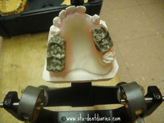 Stu-DENT Diaries: Fabrication of Removable Partial Dentures
