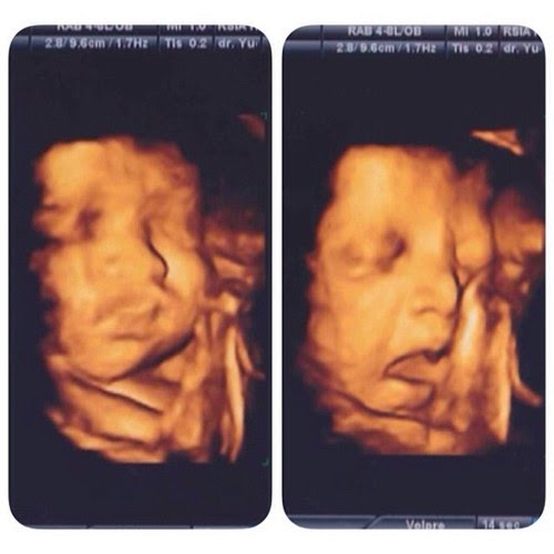 Welcome to The Brahmantyo's: Ultrasonography 4-Dimension