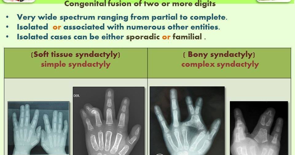 Easy Radiology: Congenital Bone diseases & malformation and normal ...