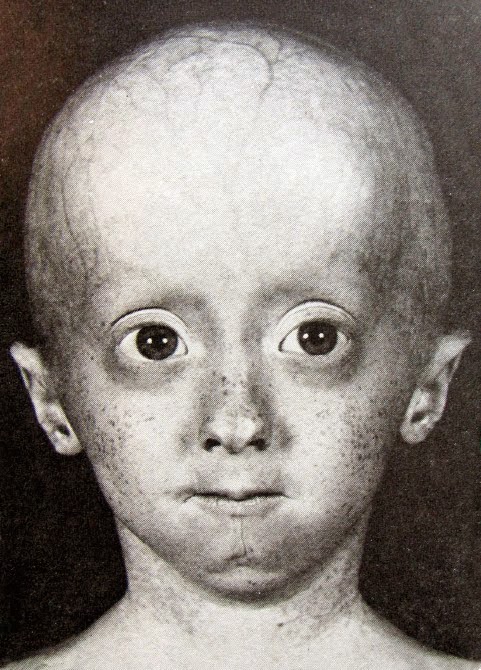 Progeria Family Circle: La progéria