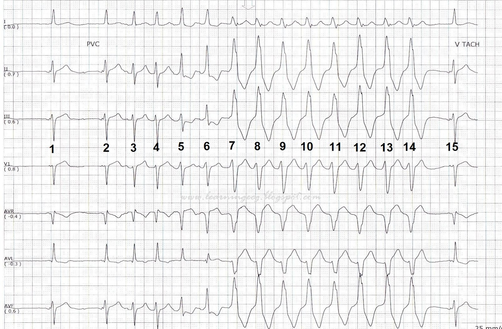 ECG Rhythms: Fusion Beats