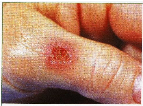 Oasis SVT: Exos 3è-Maladies infectieuses et hygiène
