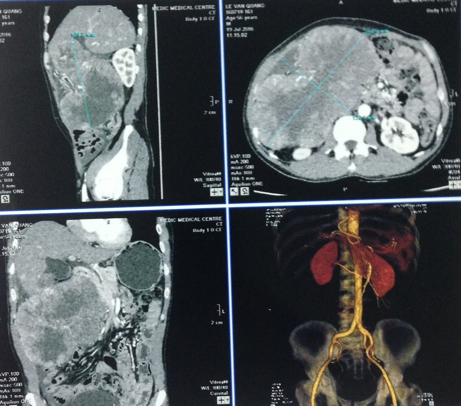VIETNAMESE MEDIC ULTRASOUND: CASE 390: PEDUNCULATED HCC, Dr PHAN THANH ...