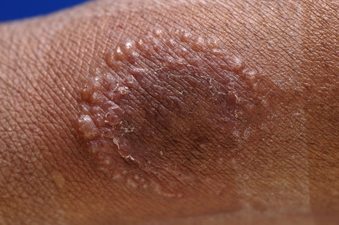 Tinea Corporis Nedir? Belirtileri, Nedenleri, Tanısı ve Tedavisi
