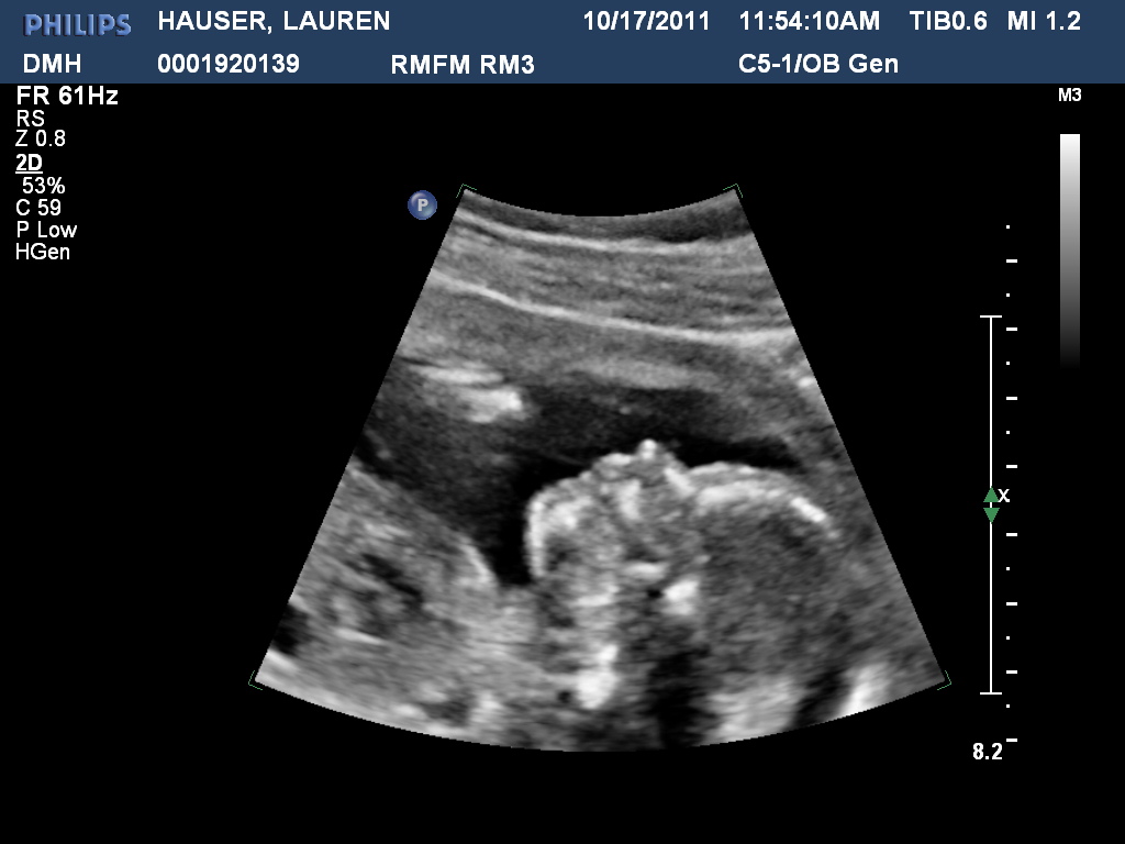 TheHauserHaus: New Baby Girl - Anatomy Scan @ Riverside