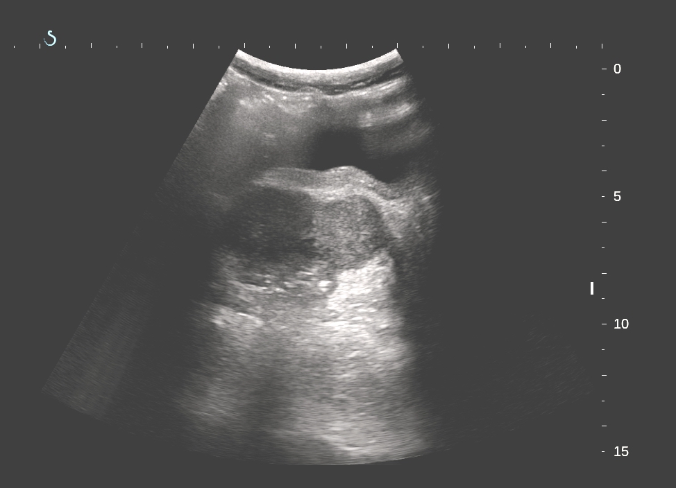 VIETNAMESE MEDIC ULTRASOUND: CASE 352: PROSTATE TUBERCULOSIS, Dr PHAN ...