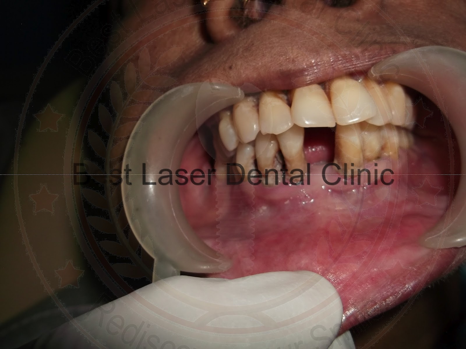 » gallery 8-extraction of shaky lower front tooth and immediate Bi ...