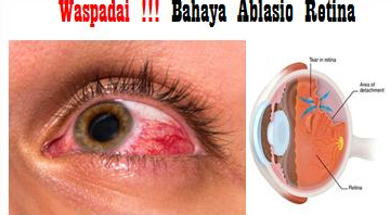 Asuhan Keperawatan Dan Biaya Operasi Penyakit Ablasio Retina ( Retina ...