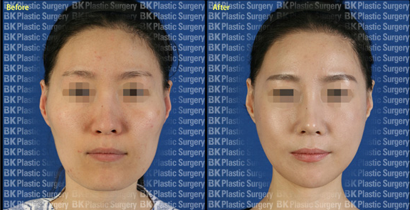 BK Plastic Surgery: [BK Plastic Surgery] 3D Cheekbone Reduction