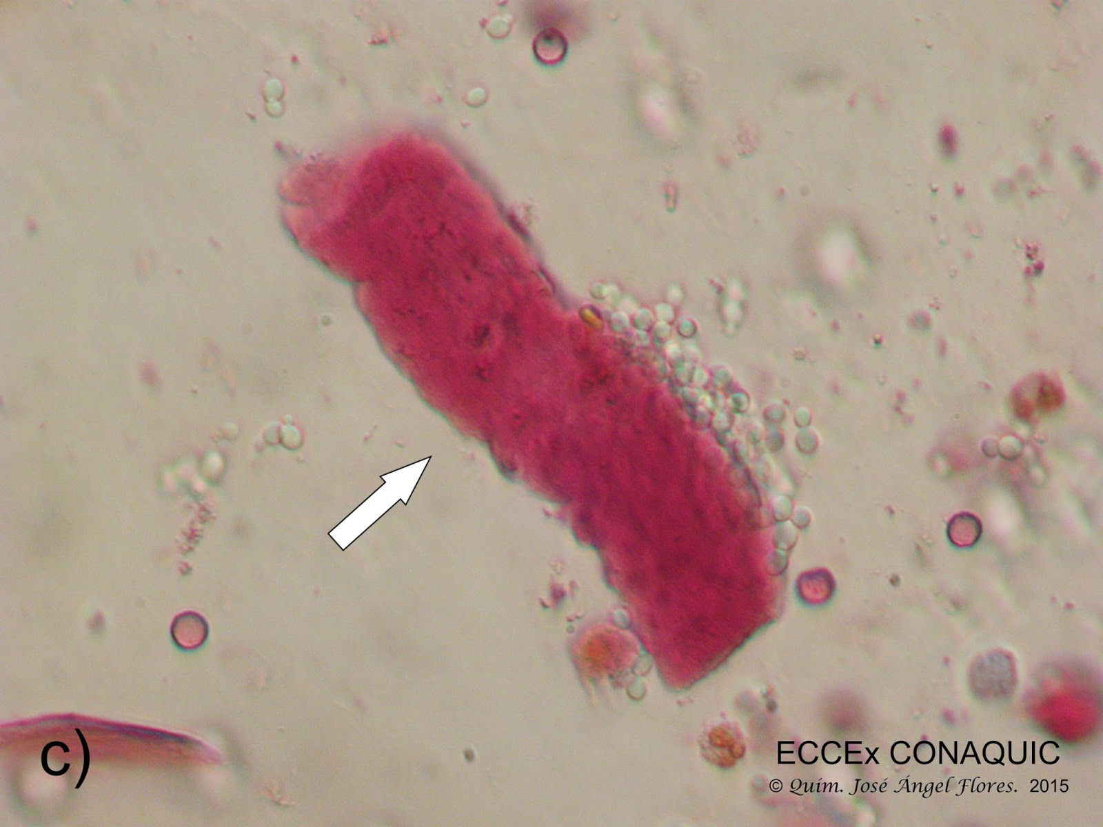Examen General de Orina: Caso UR-julio-15 (Enfoque: Cilindruria)