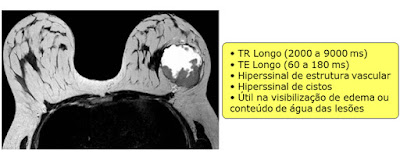 Advanced Radiology: Ressonância Magnética das Mamas