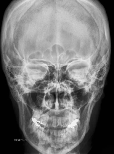 RADIOLOGIA e IMAGEN CETIS 76: SENOS PARANASALES