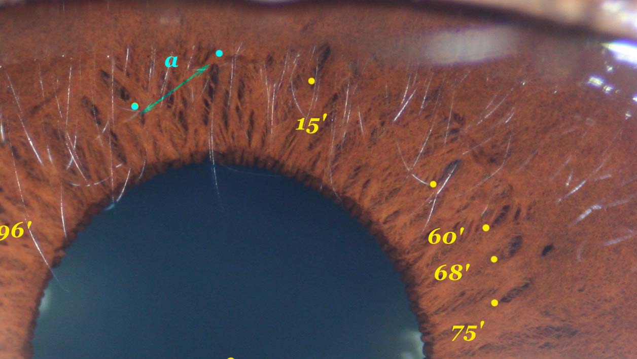 Modern & Multidimensional Iridology: Crypts, Internal Lacunae ...