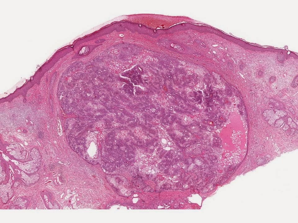 Dermpath Made Simple - Neoplastic: Sebaceous Tumours
