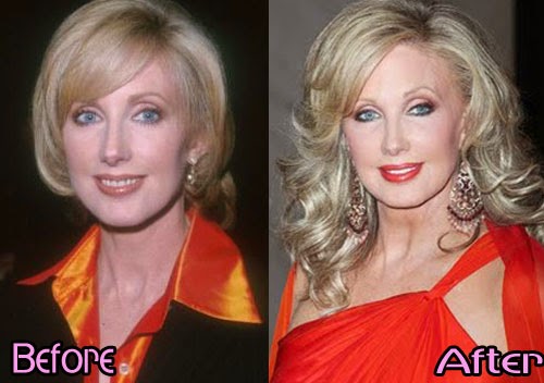 Morgan Fairchild Plastic Surgery
