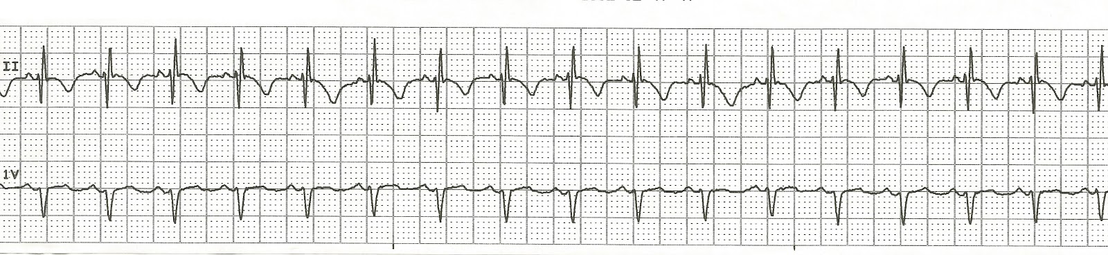 Practice EKG Rhythm Strips 99