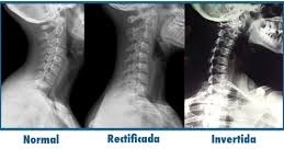 5. Pilates y las cervicales