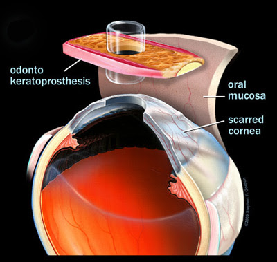 dentisTRY: EYETOOTH IMPLANT: Tooth implantation in eye for blind person