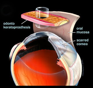dentisTRY: EYETOOTH IMPLANT: Tooth implantation in eye for blind person