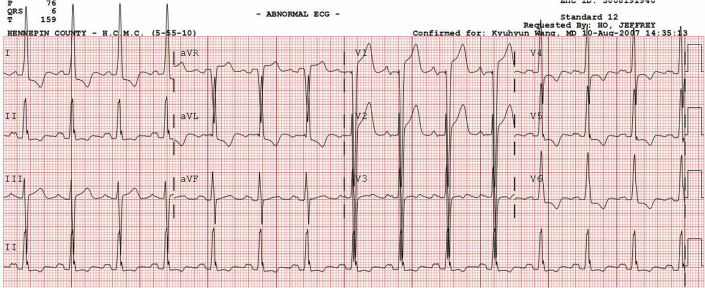 Dr. Smith's ECG Blog: LVH with secondary ST depression??