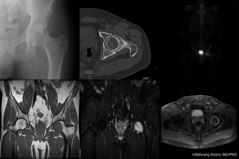 Roentgen Ray Reader: Clear Cell Variant of Chondrosarcoma
