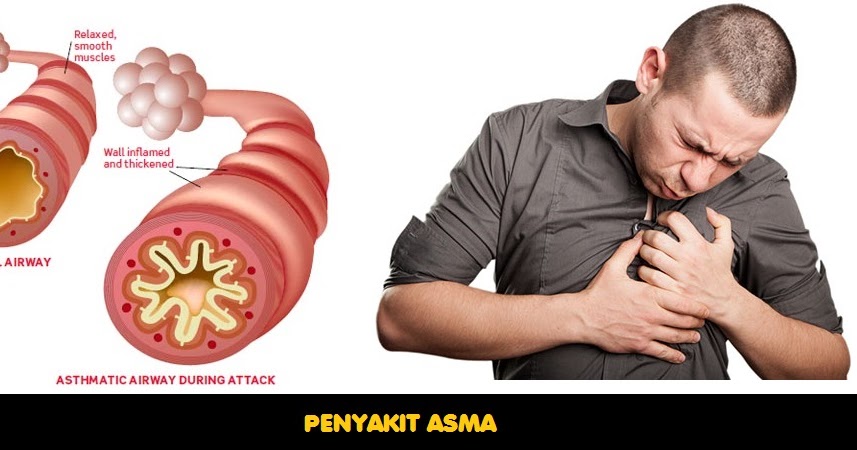 Gejala dan Ciri-Ciri Penyakit Asma