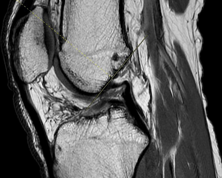 Signs of ACL tear on MRI- Resident's Corner - Sumer's Radiology Blog