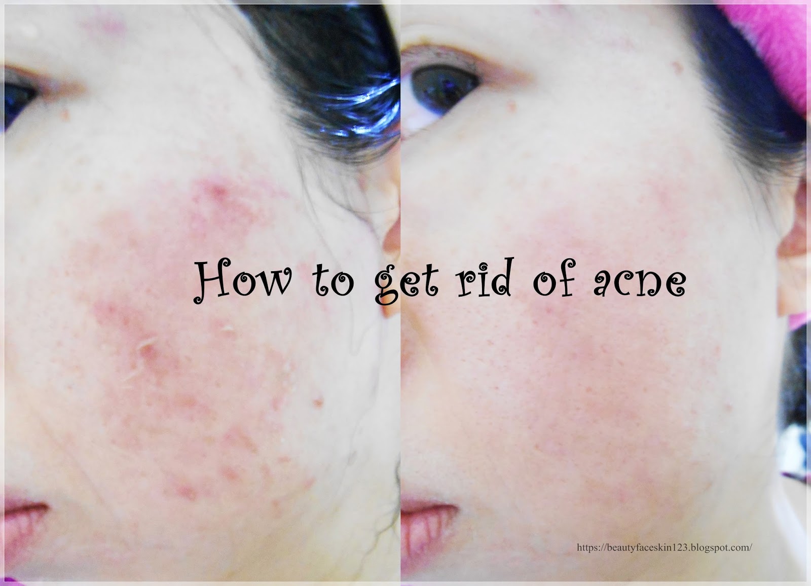 GREAT SKINandLIFE: HOW TO GET RID OF ACNE AND ASIAN SKINCARE TIPS FOR ACNE