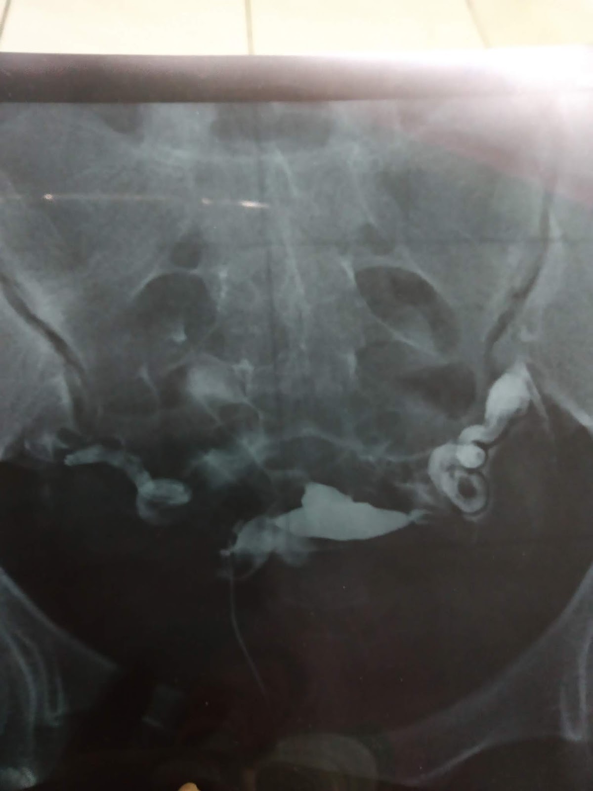 Tara Stories Blog: Program Hamil (Promil) -------- HSG