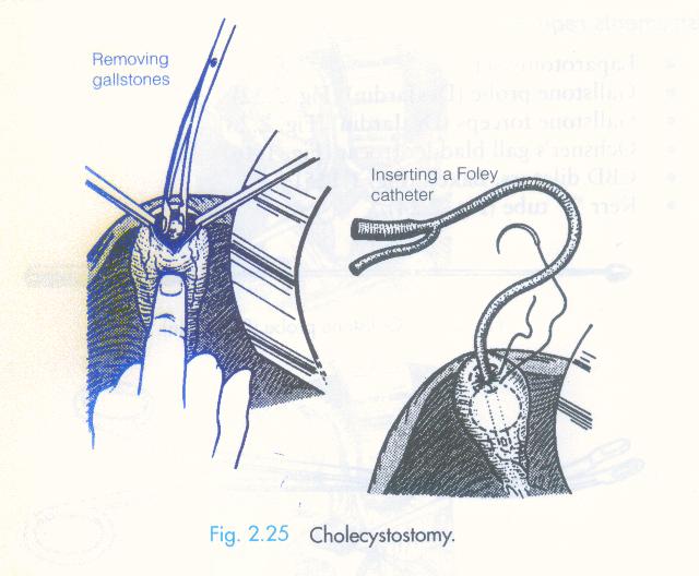 OTMANAGE: PROCEDURE Cholecystostomy