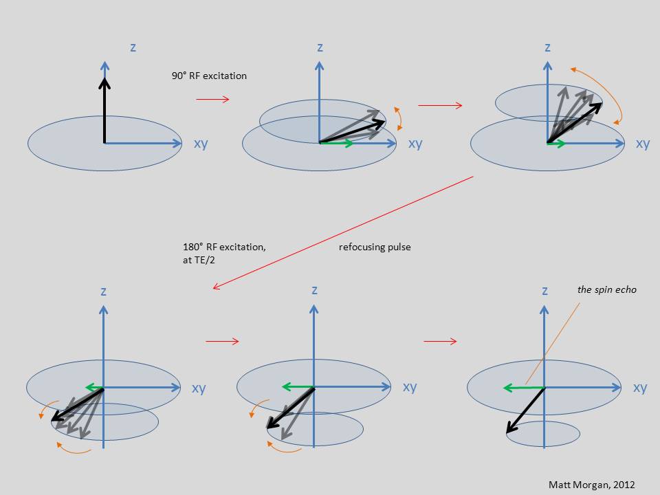 The Pump and the Tubes: Maximum fluid intensity -- bSSFP MRA