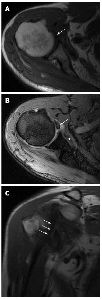MRI Musculo-Skeletal Section: Long head biceps tendon