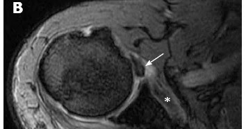 MRI Musculo-Skeletal Section: Long head biceps tendon